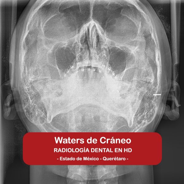 Waters de Cráneo – Orthodiagnóstico